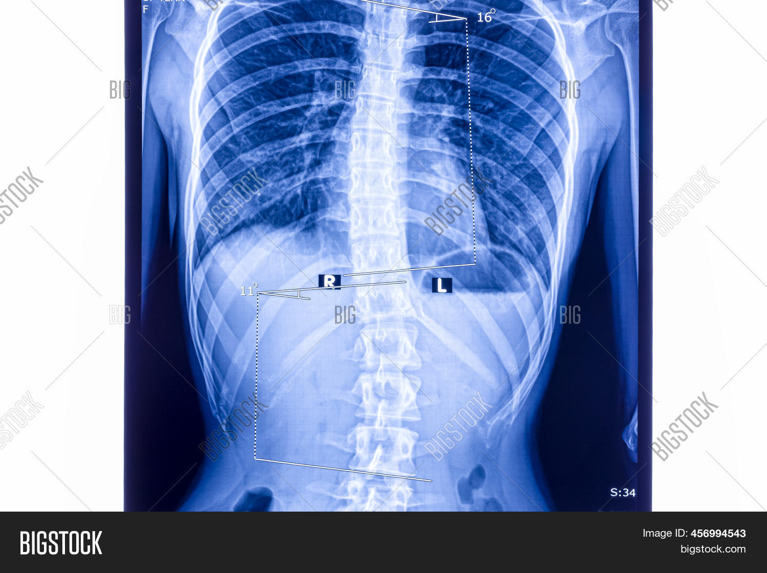 X Ray Showing Image And Photo Free Trial Bigstock
