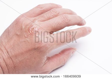 Scratches On Back Hand Image & Photo (Free Trial) | Bigstock