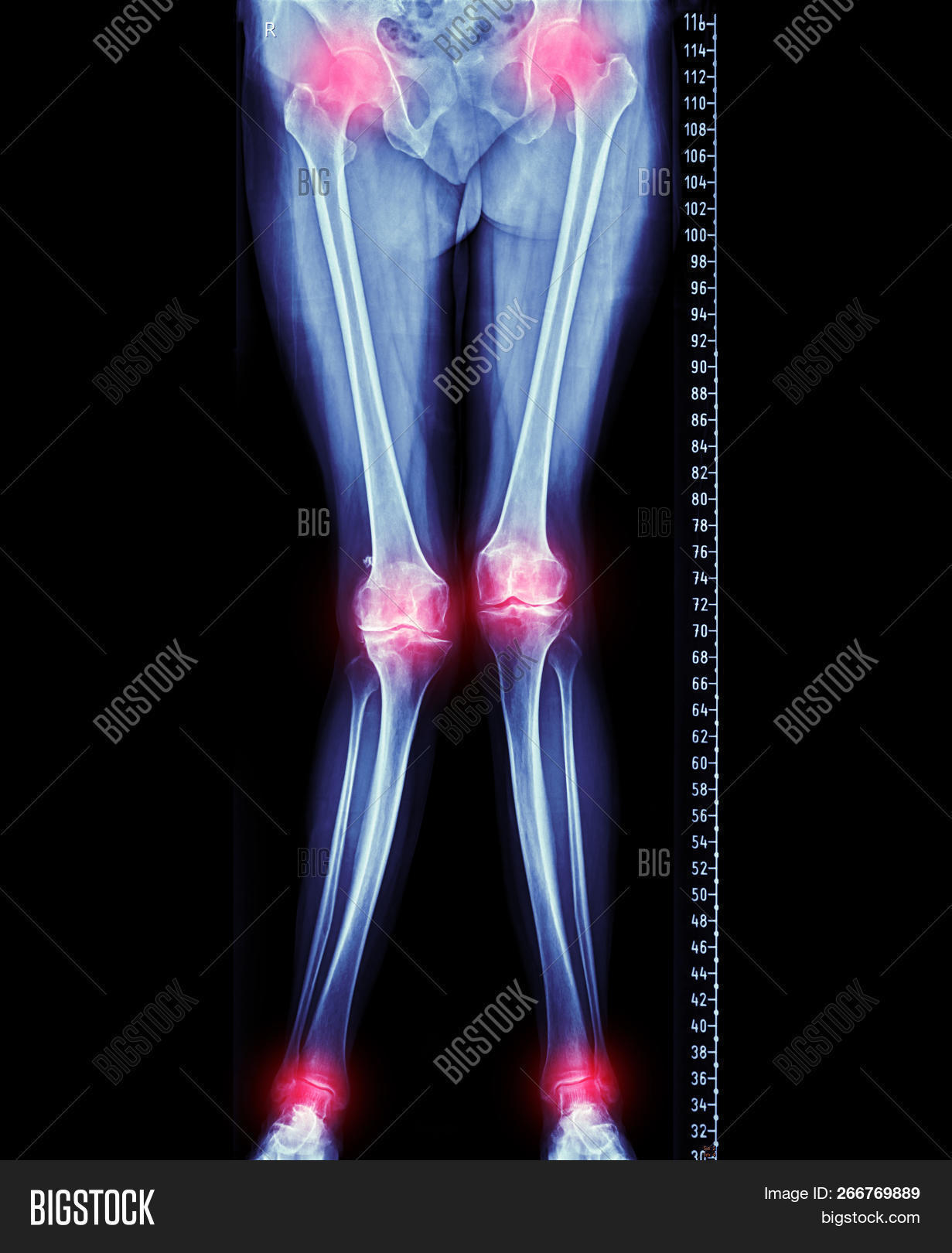 X-ray Image Lower Limb Image & Photo (Free Trial) | Bigstock