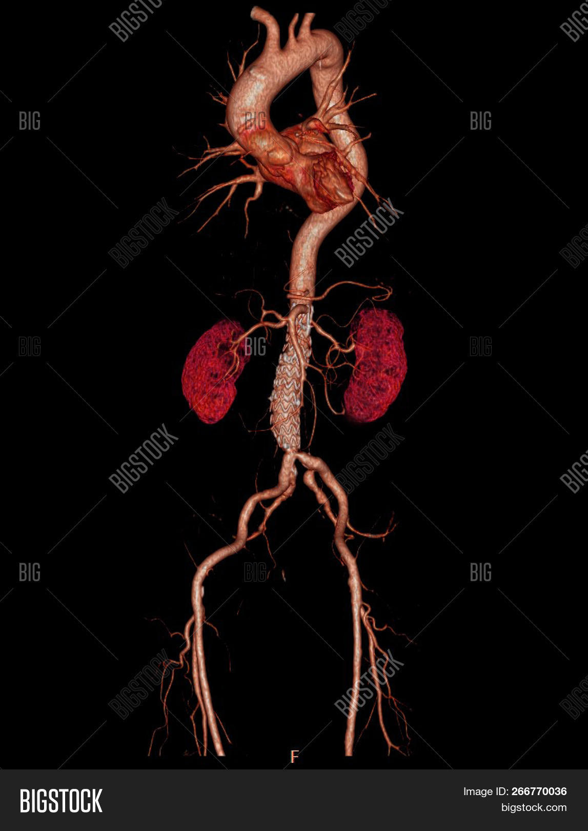 Ct Angiographphy Whole Image & Photo (Free Trial) | Bigstock
