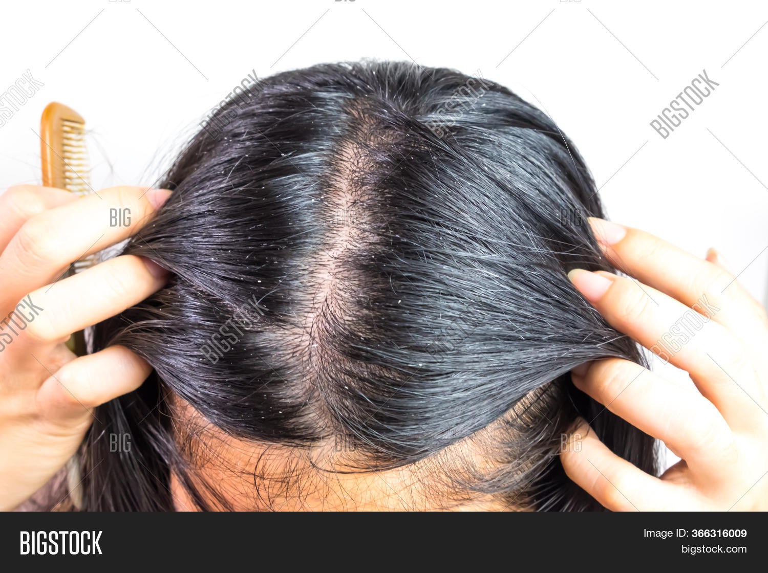 Women Head Dandruff Image & Photo (Free Trial) | Bigstock