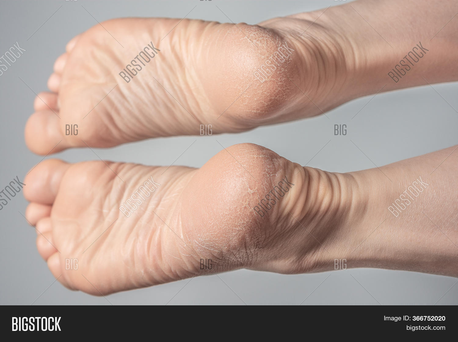 Dry Cracked Soles Feet Image & Photo (Free Trial) | Bigstock
