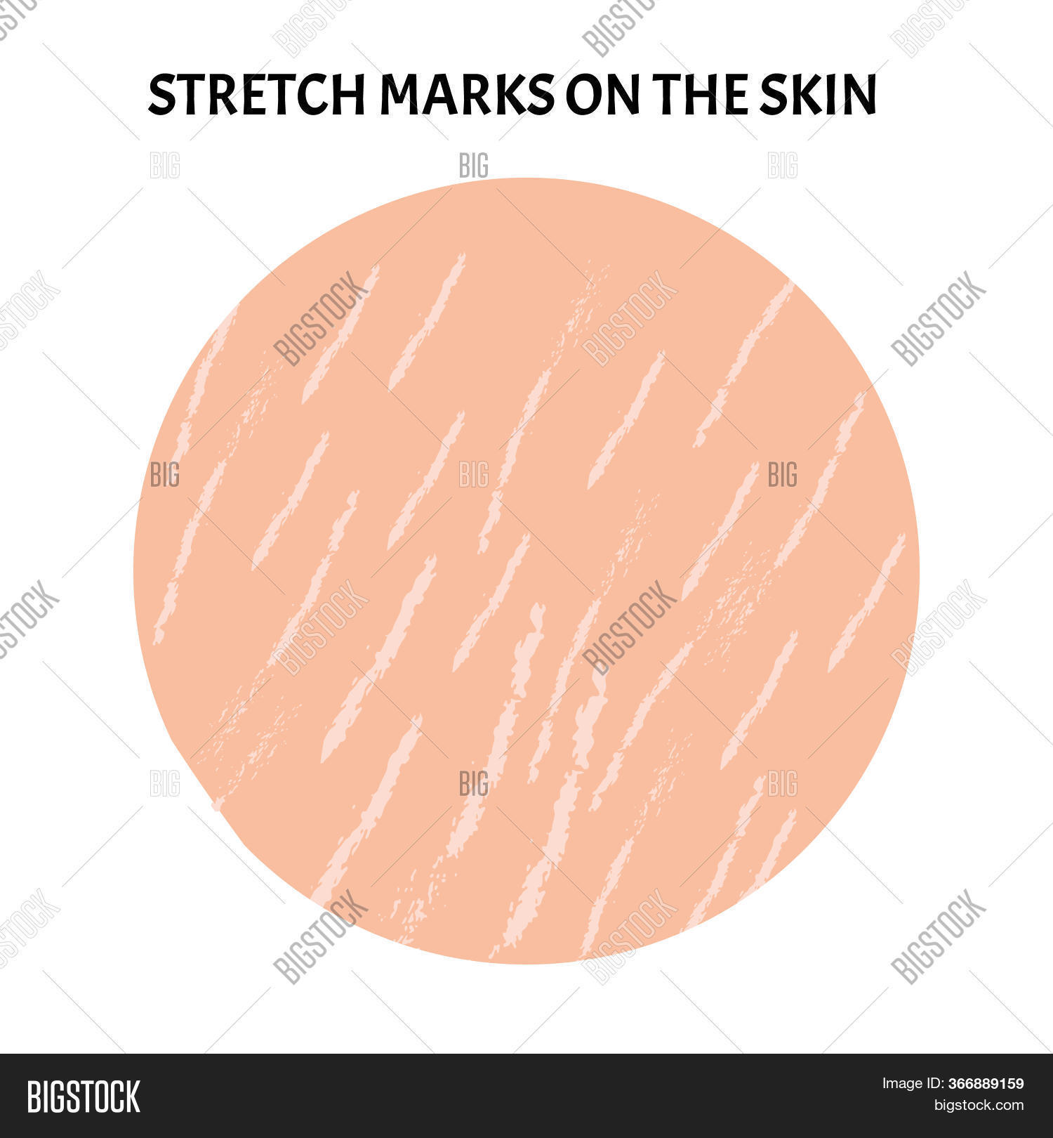 Stretch Marks On Skin Image & Photo (Free Trial) | Bigstock