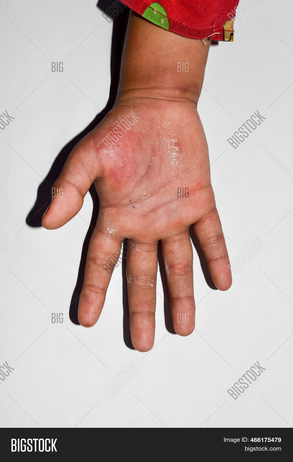 Unilateral Edema Image & Photo (Free Trial) | Bigstock