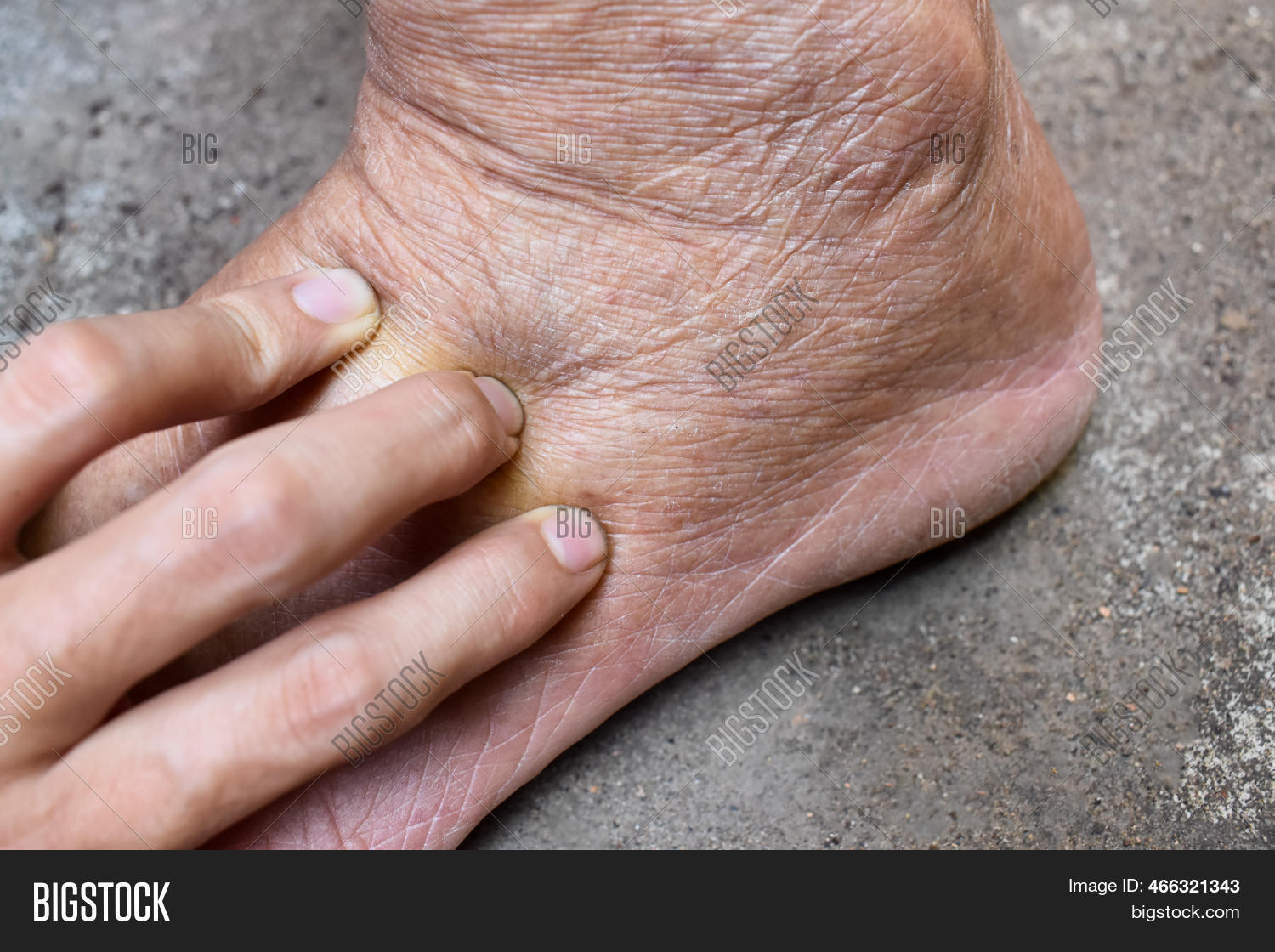 Pitting Edema Lower Image & Photo (Free Trial) | Bigstock