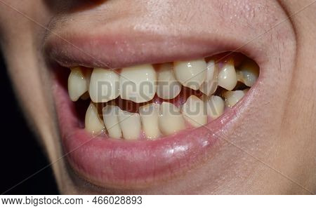 Stacked Impacted Teeth Image & Photo (Free Trial) | Bigstock