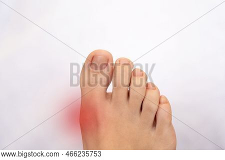 Foot Disease Image & Photo (Free Trial) | Bigstock