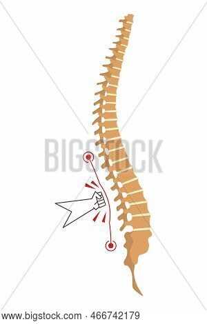 Spinal Deformity. Vector & Photo (Free Trial) | Bigstock