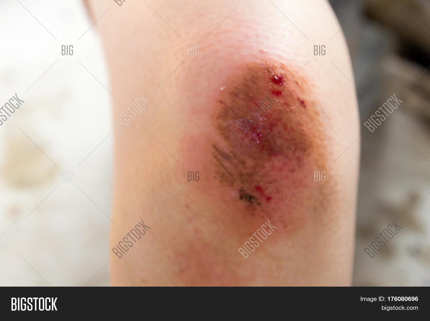 Bruised Wound Injury Image & Photo (Free Trial) | Bigstock