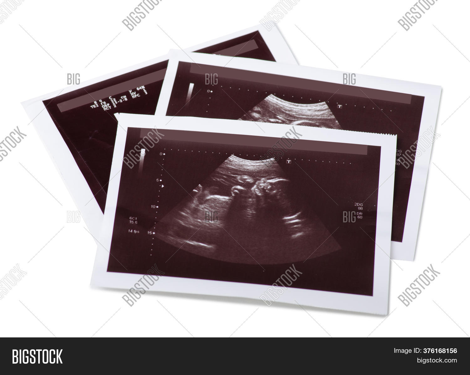Ultrasound Film Baby Image & Photo (Free Trial) | Bigstock