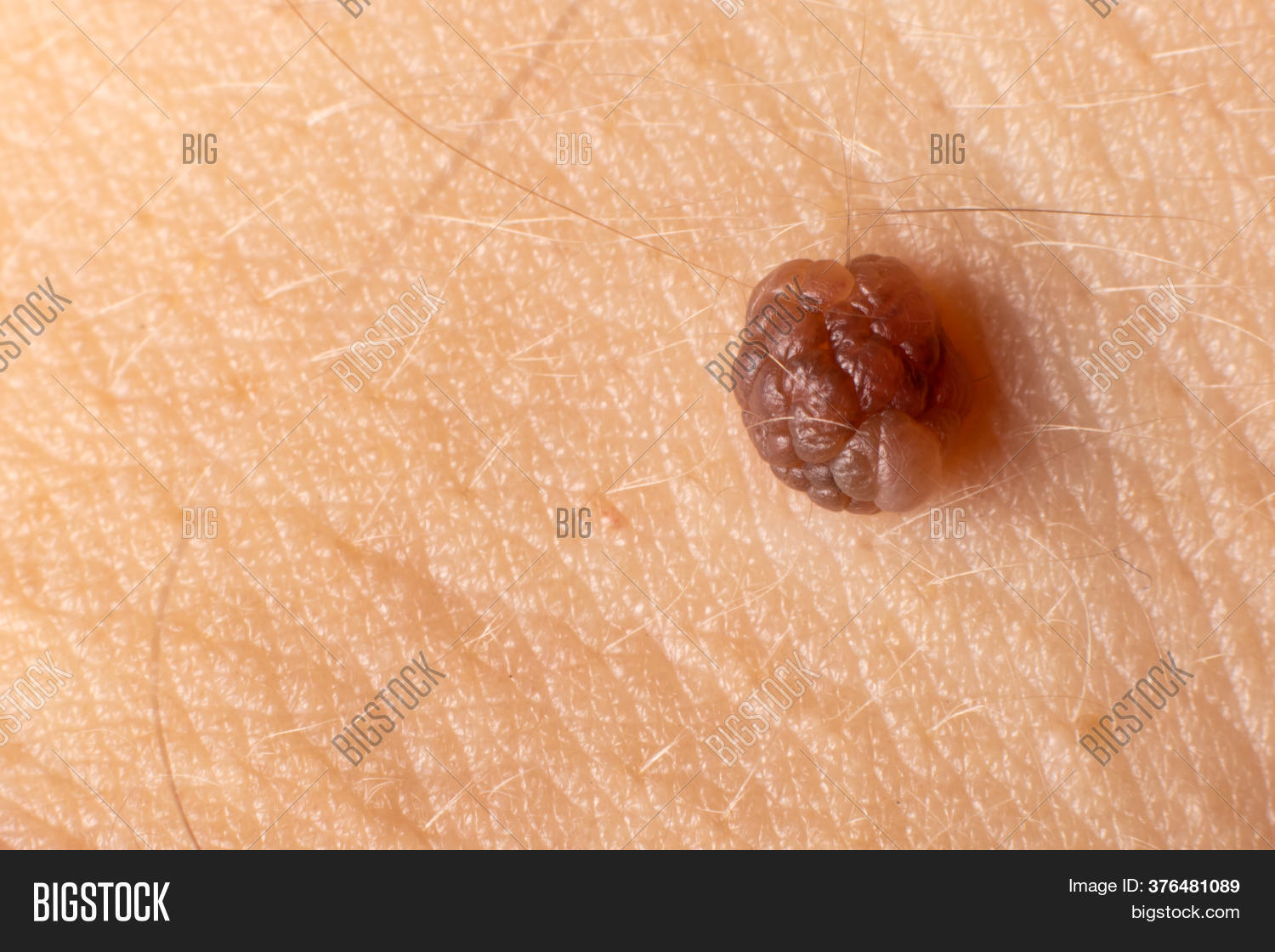 Mole Birthmark Nevus Image & Photo (Free Trial) | Bigstock