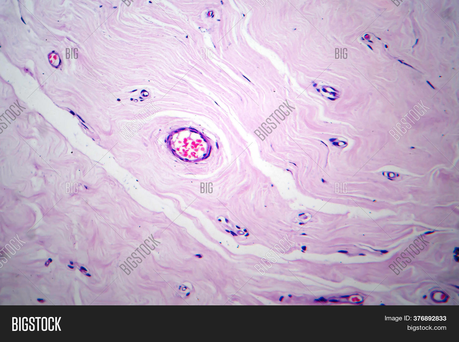 Uterus Adenofibroma, Image & Photo (Free Trial) | Bigstock