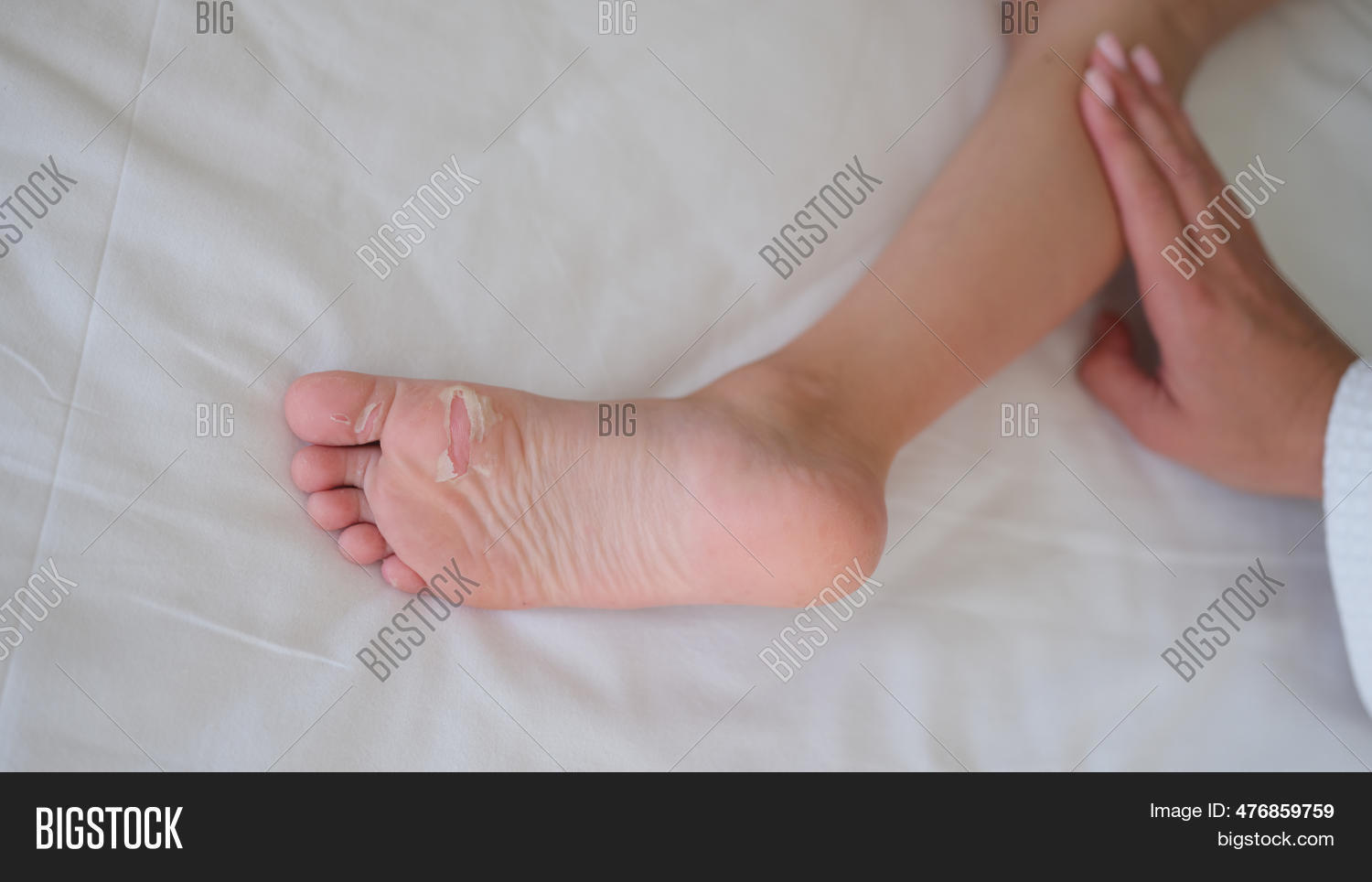 Child Foot Flaky Skin Image & Photo (Free Trial) | Bigstock