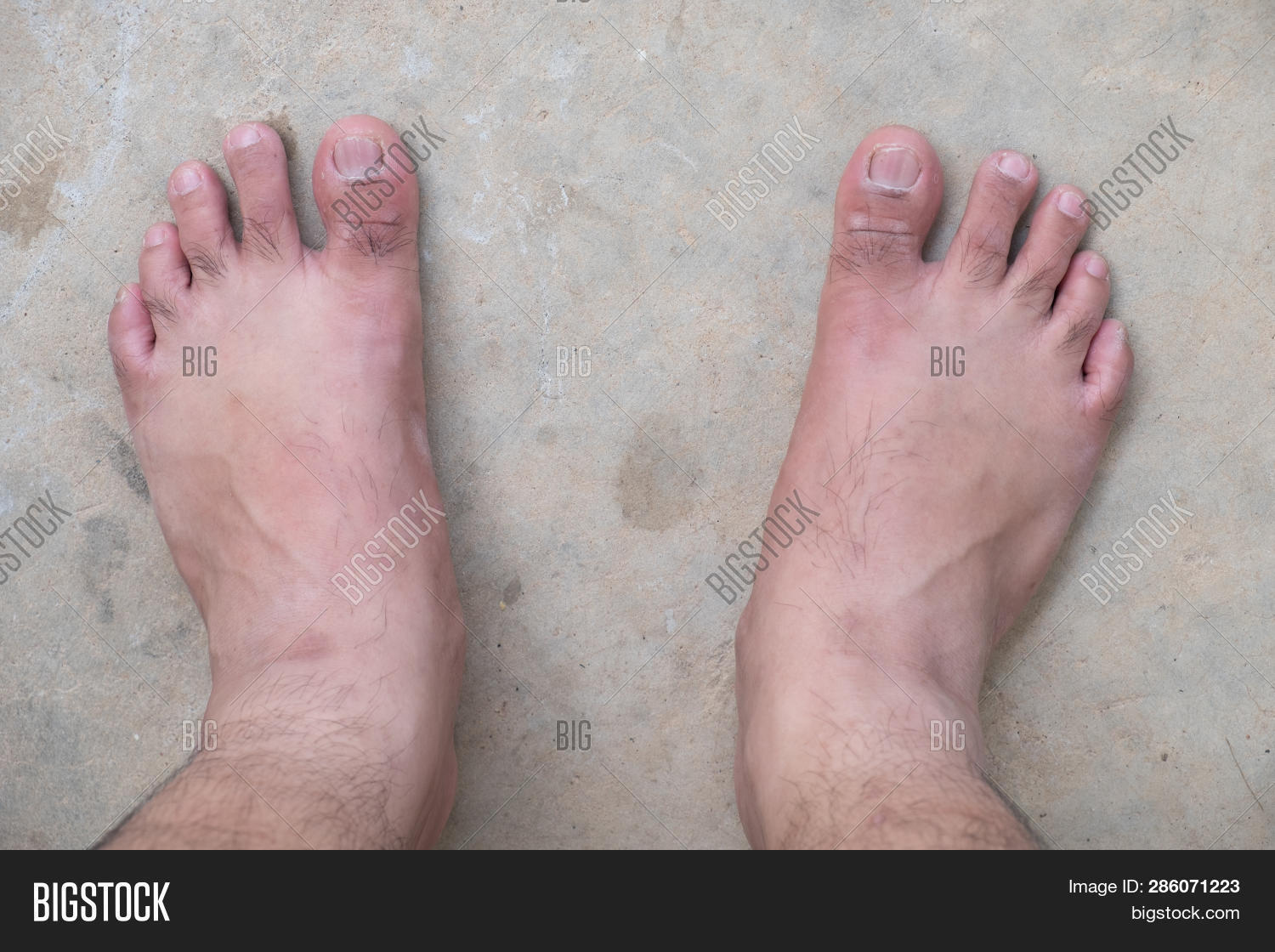 Lap Feet Flat Foot Image & Photo (Free Trial) | Bigstock
