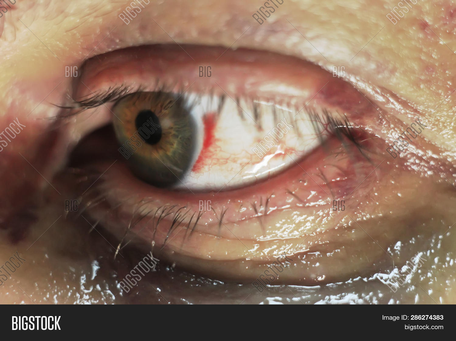 Eye Injury Bruises Image & Photo (Free Trial) | Bigstock