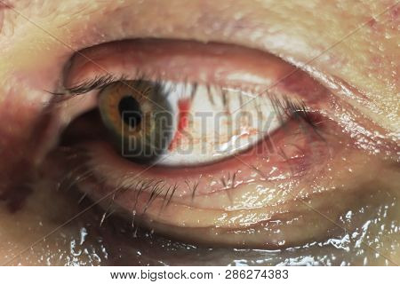 Eye Injury Bruises Image & Photo (Free Trial) | Bigstock