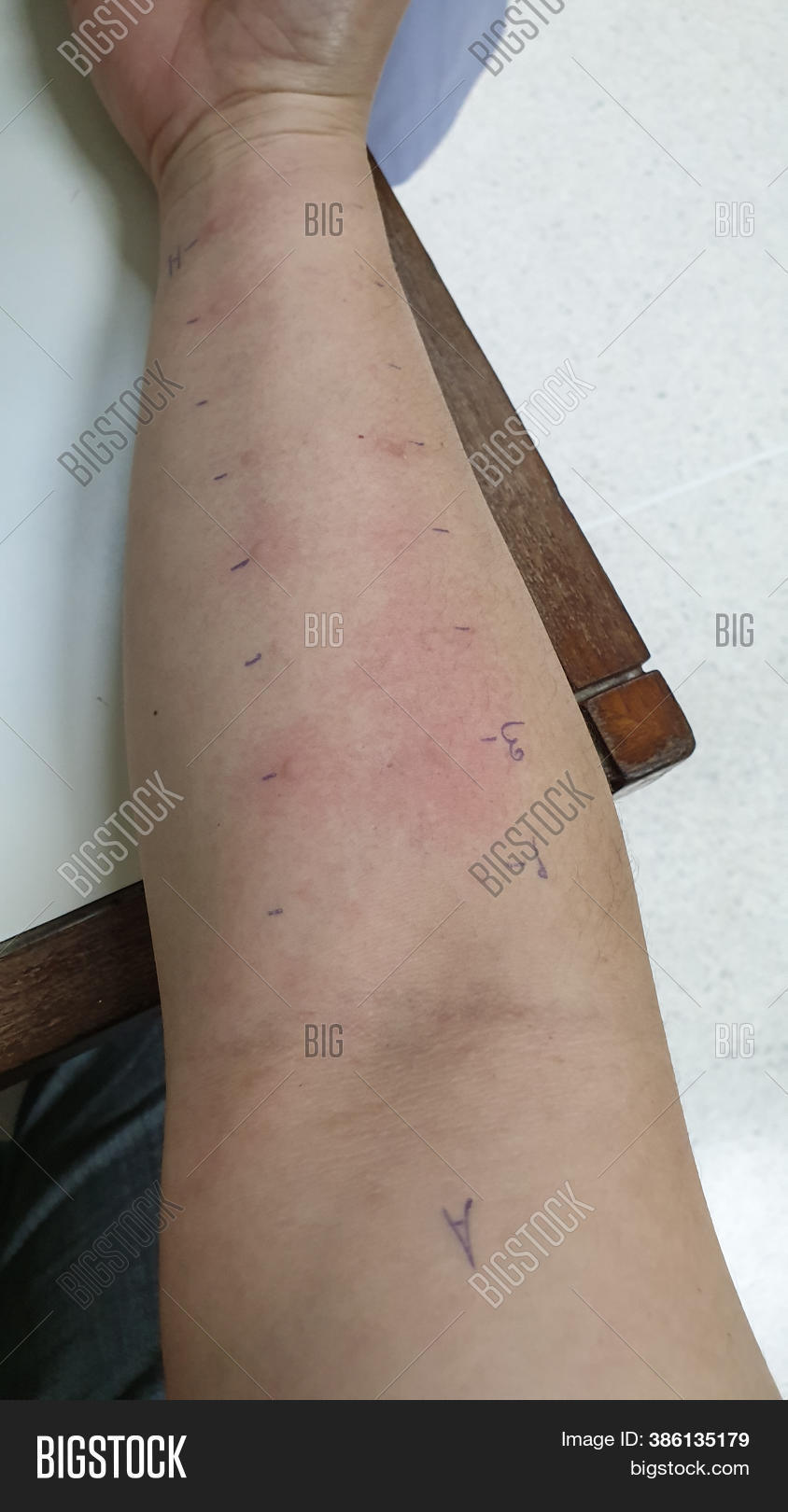 Arm Test Allergy Image & Photo (Free Trial) | Bigstock