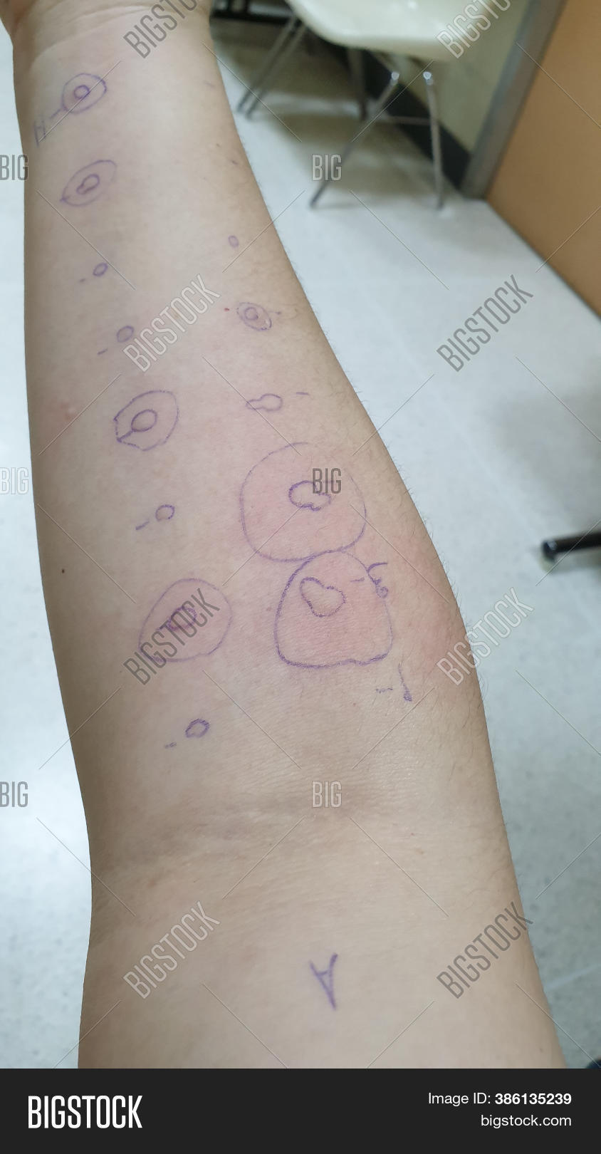 Arm Test Allergy Image & Photo (Free Trial) | Bigstock