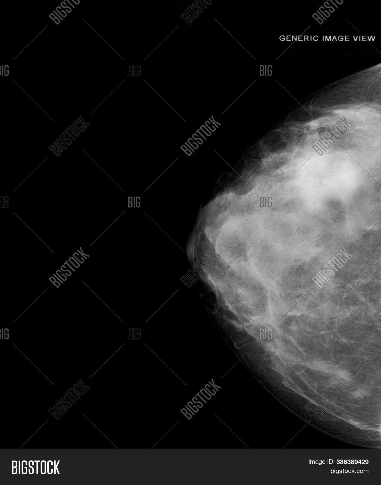X-ray Mammography Image & Photo (Free Trial) | Bigstock