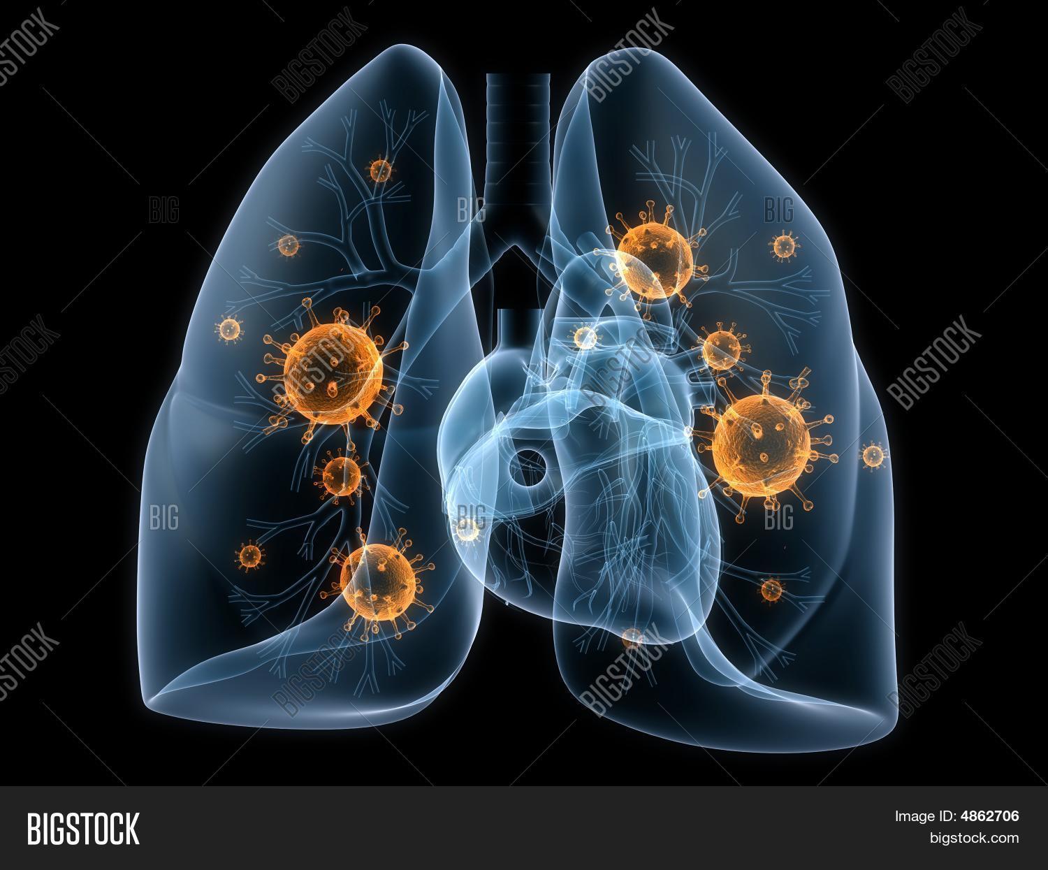 Lung Bacteria Image & Photo (Free Trial) | Bigstock