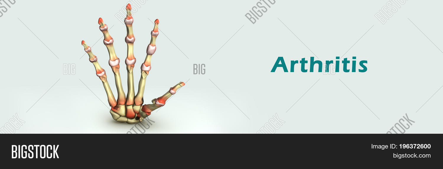 When Joints Affected Image & Photo (Free Trial) | Bigstock