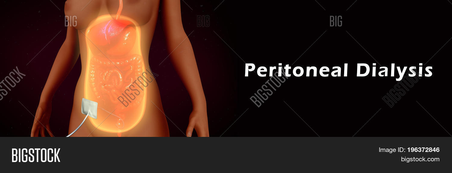 Peritoneal Dialysis ( Image & Photo (Free Trial) | Bigstock