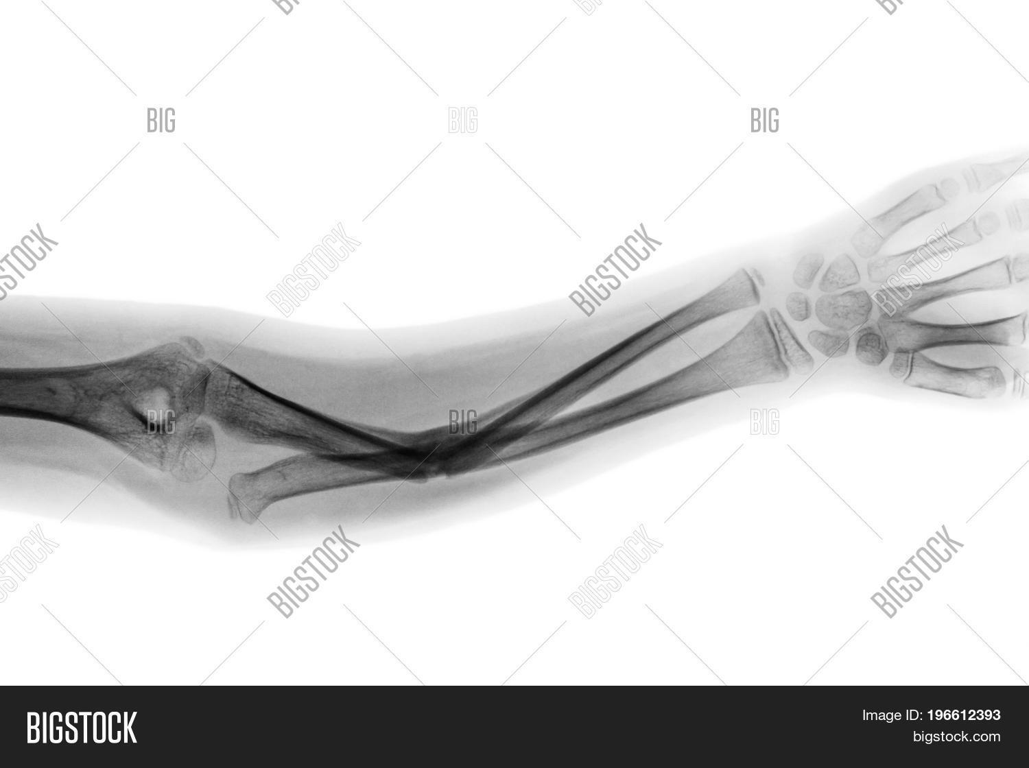Film X-ray Forearm AP Image & Photo (Free Trial) | Bigstock