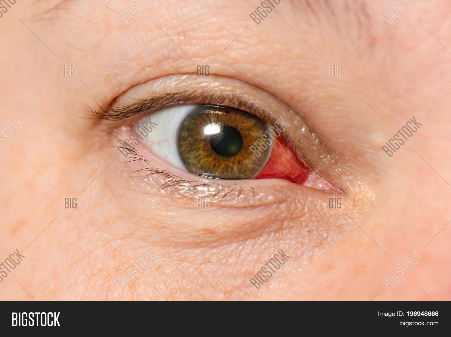 Subconjunctival Image & Photo (Free Trial) | Bigstock
