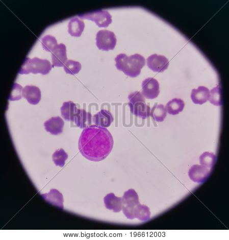 Blast Cell On Blood Image & Photo (Free Trial) | Bigstock