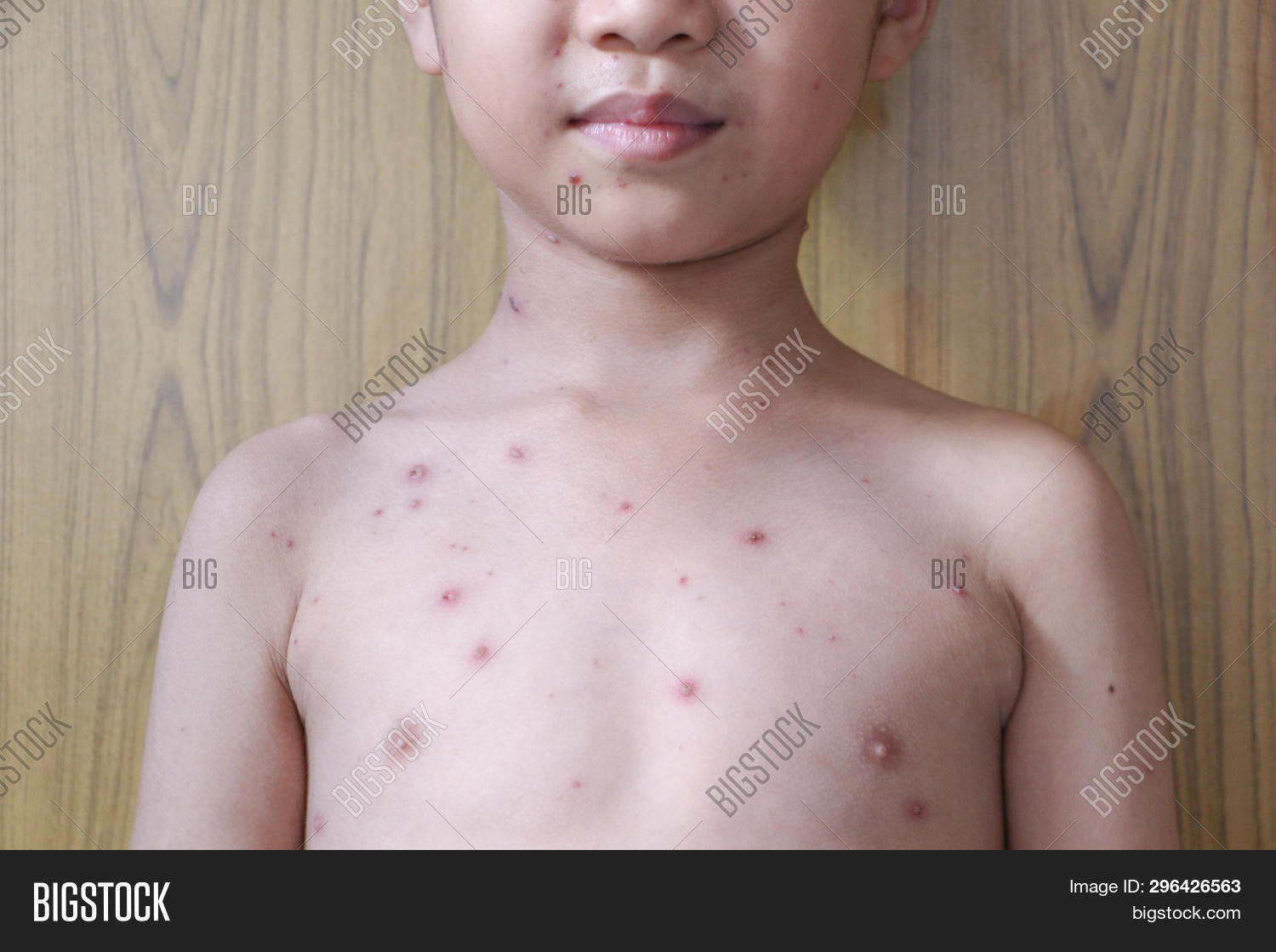 Chicken Pox Rash On Image & Photo (Free Trial) | Bigstock