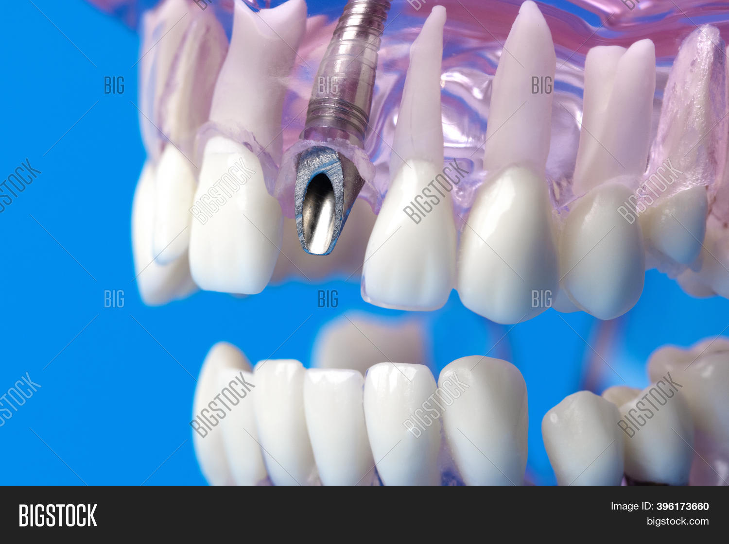 Dental Implant Screw Image & Photo (Free Trial) | Bigstock