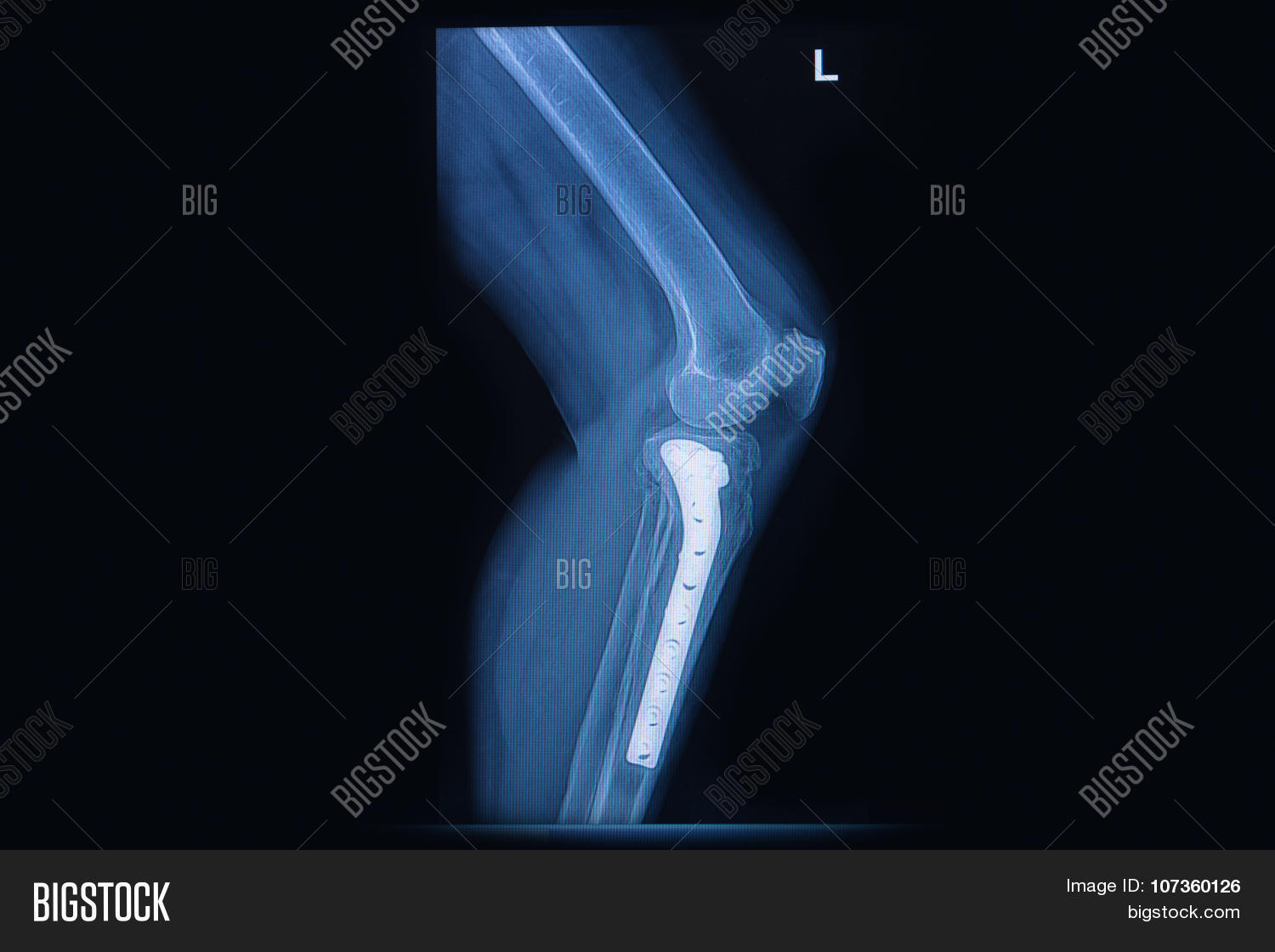 X-ray Fracture Tibia( Image & Photo (Free Trial) | Bigstock