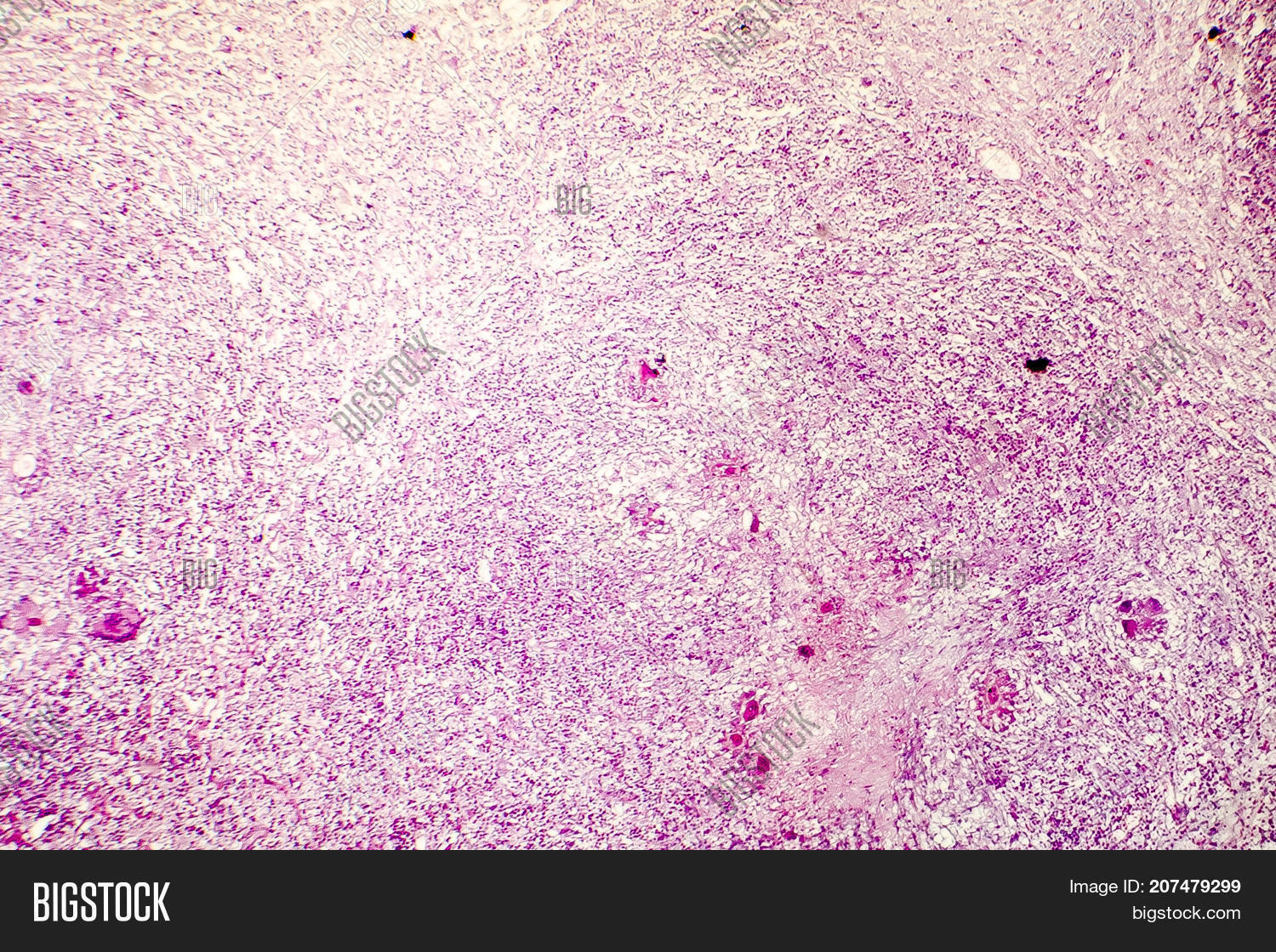 Liquefactive Necrosis Image & Photo (Free Trial) | Bigstock