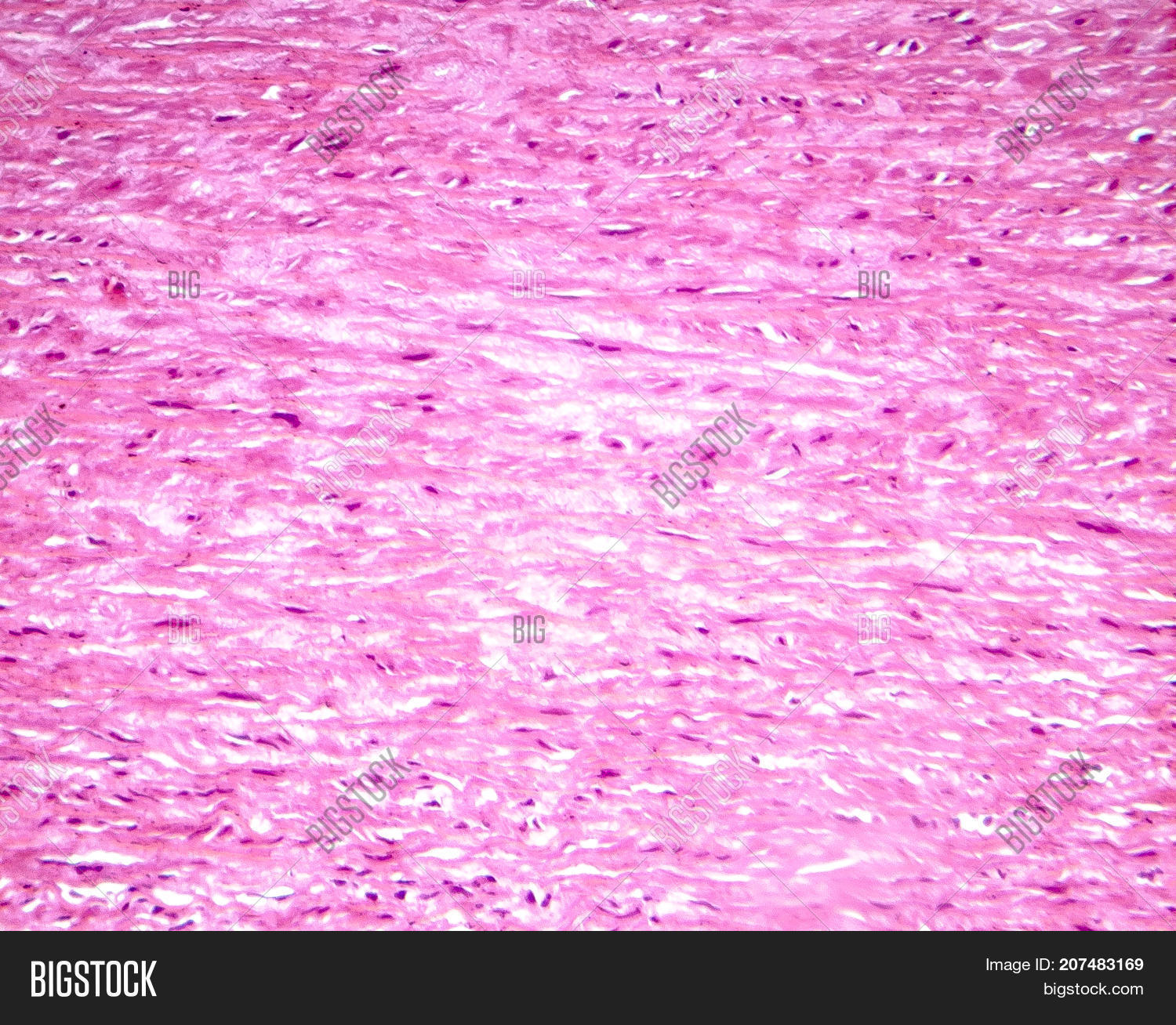 Myxoid Degeneration Image & Photo (Free Trial) | Bigstock