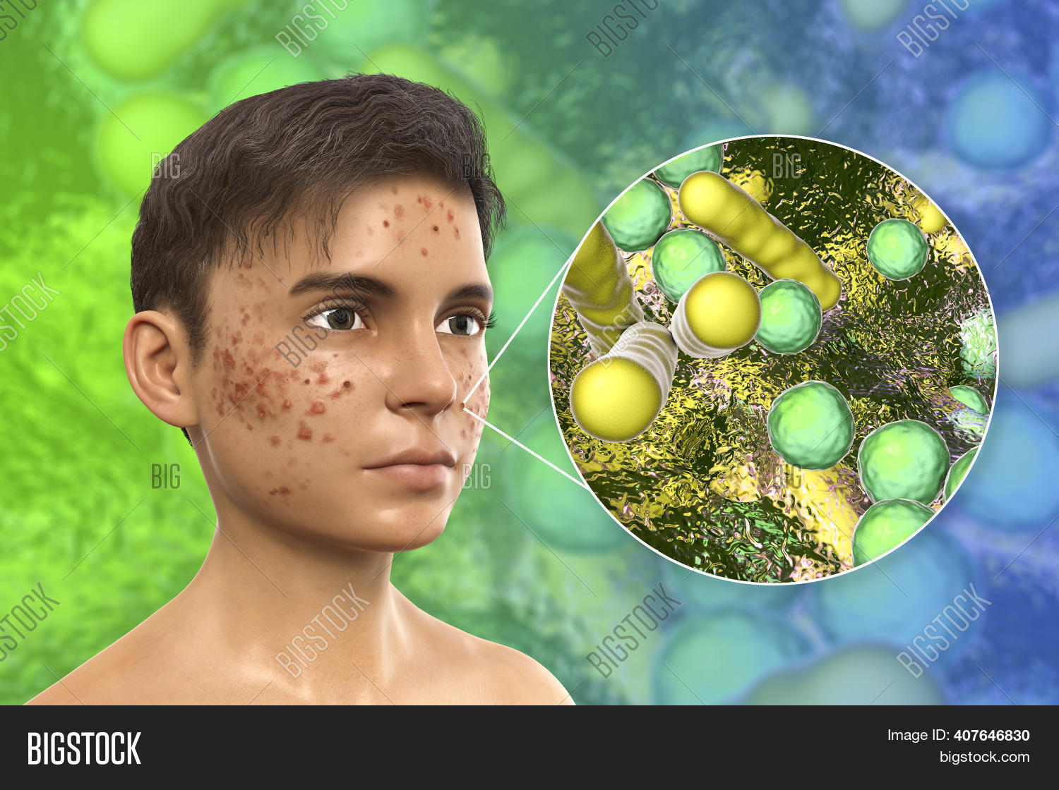 Acne, Pimples, Closeup Image & Photo (Free Trial) | Bigstock