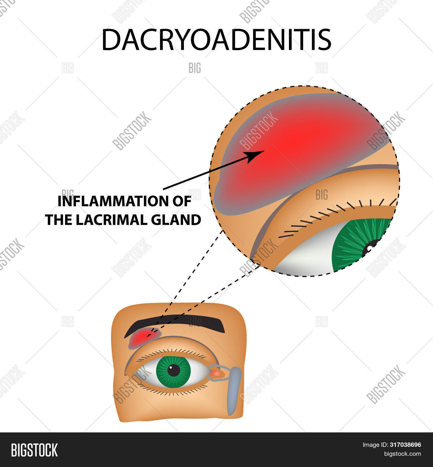 Dacryoadenitis. Image & Photo (Free Trial) | Bigstock