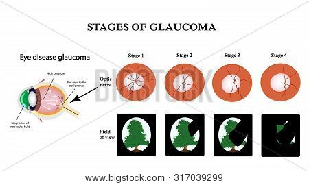 Glaucoma. Structure Image & Photo (Free Trial) | Bigstock
