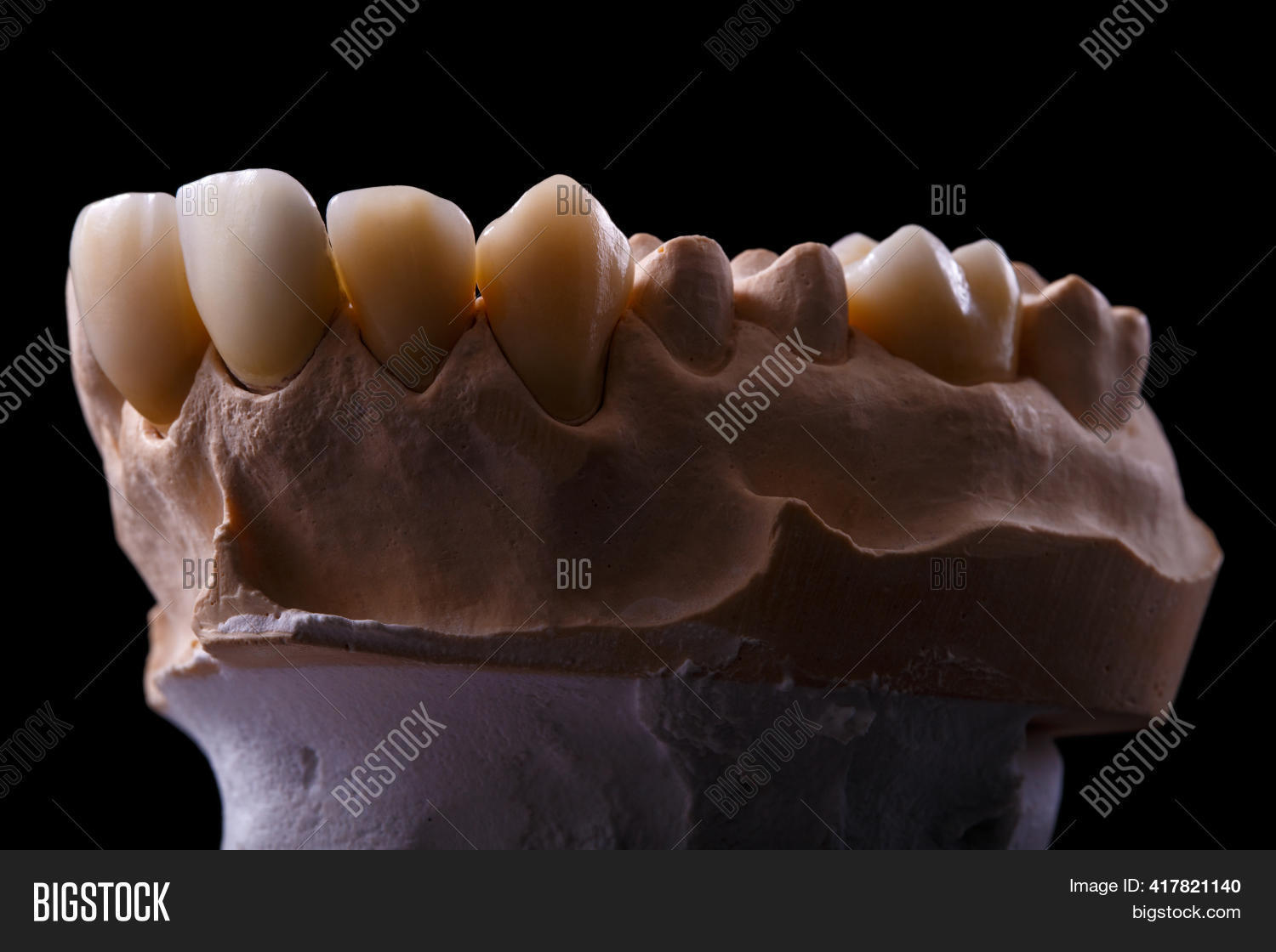 Mold Teeth. Gypsum Image & Photo (Free Trial) | Bigstock