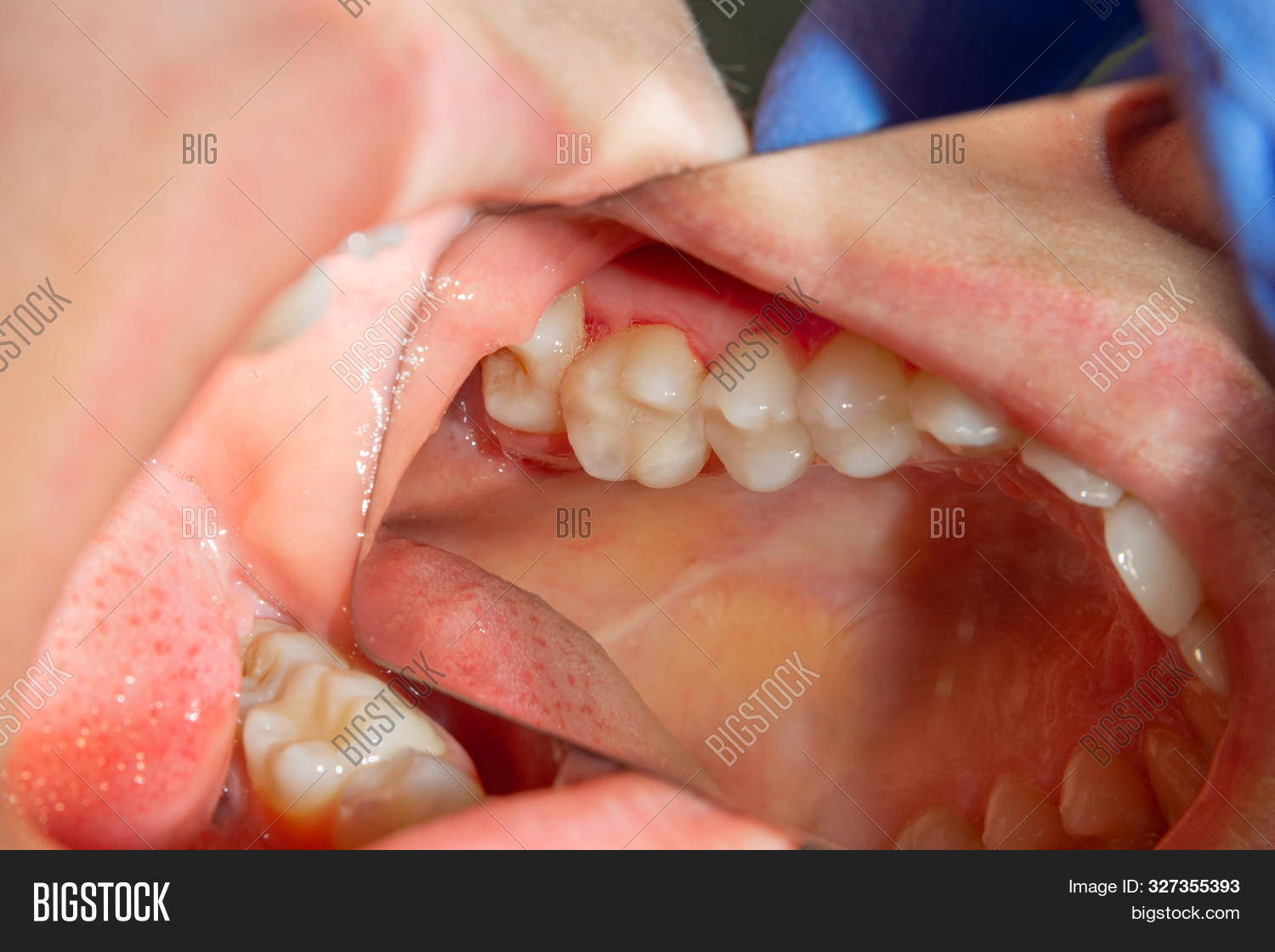 Two Chewing Side Teeth Image & Photo (Free Trial) | Bigstock