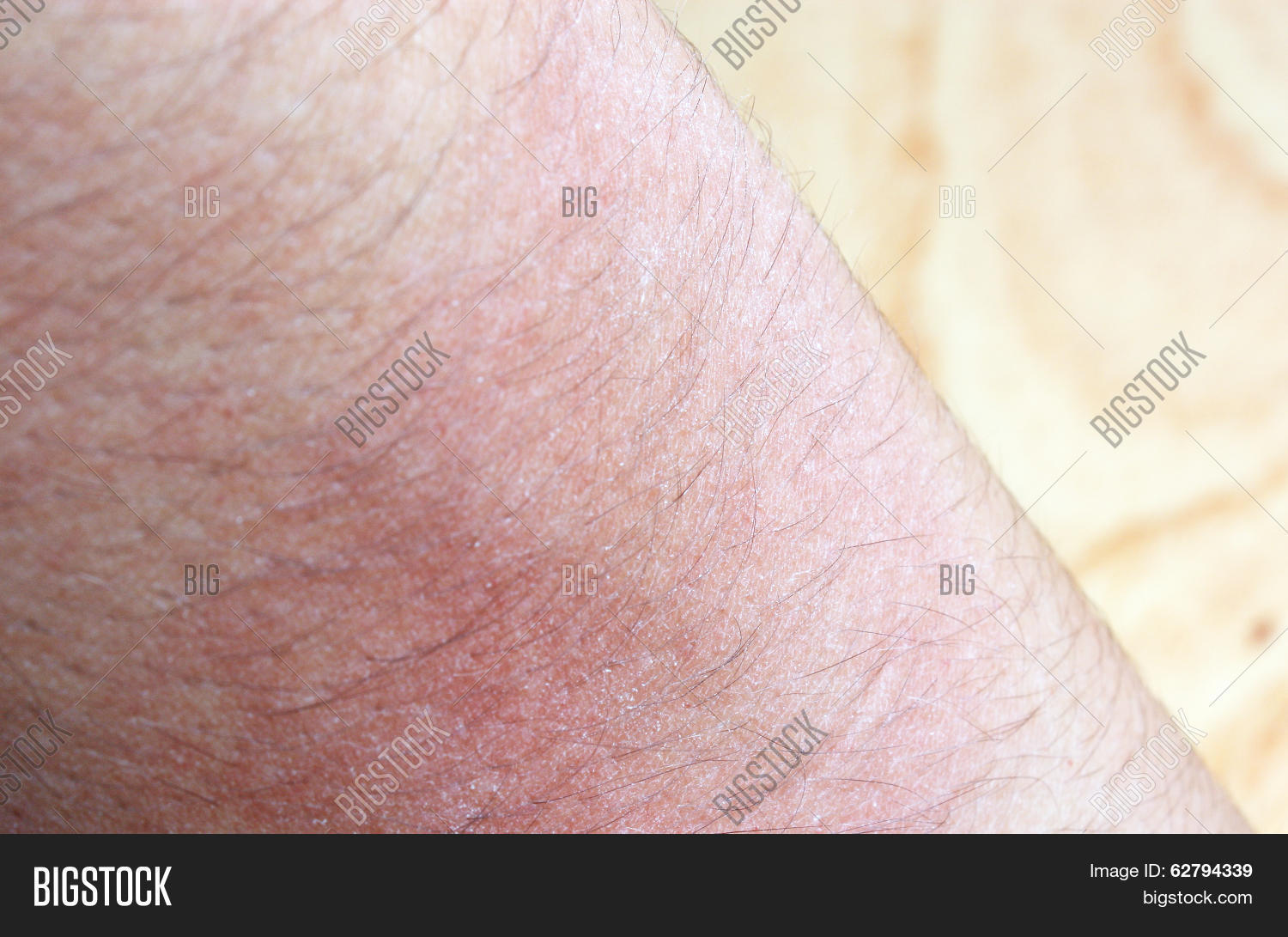 Allergic Rash Image & Photo (Free Trial) | Bigstock