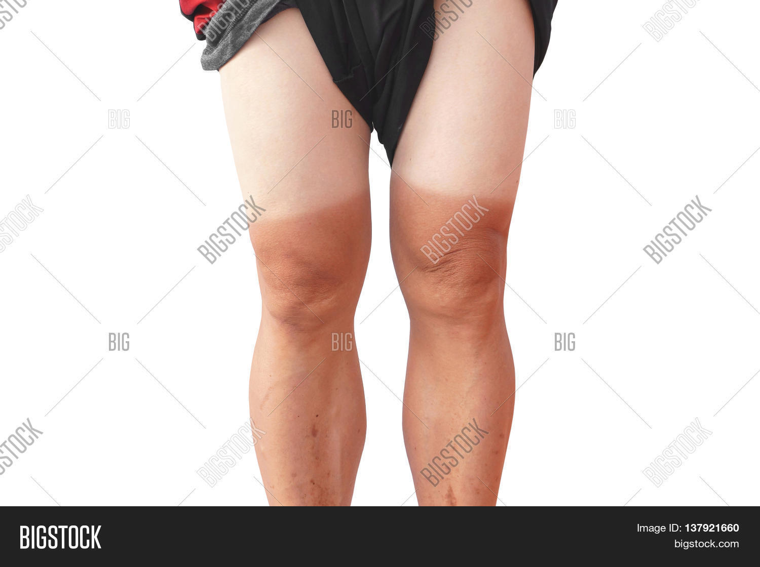 Sunburn Asian Man Image And Photo Free Trial Bigstock