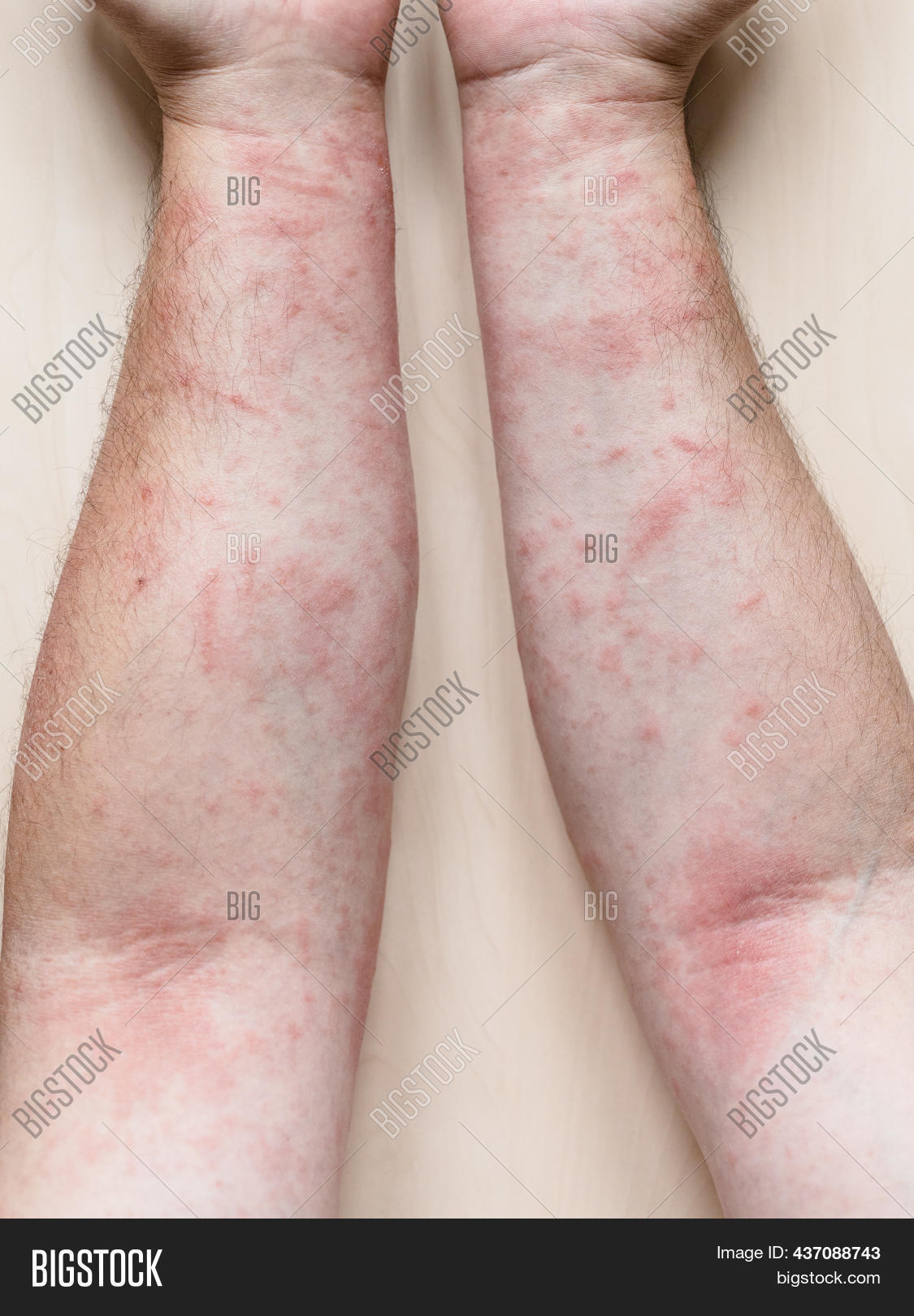 Sample Allergic Image & Photo (Free Trial) | Bigstock