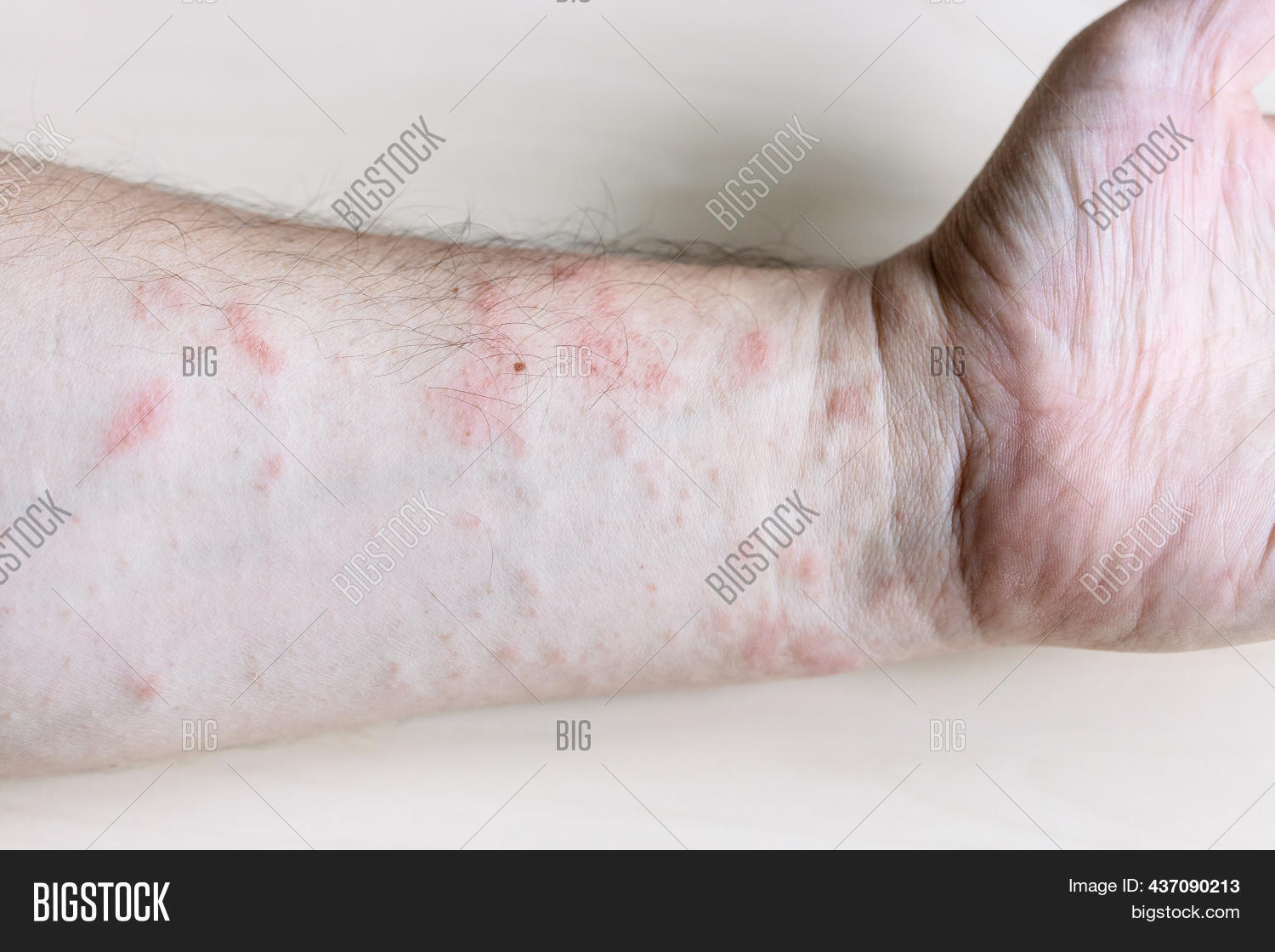Sample Allergic Image & Photo (Free Trial) | Bigstock