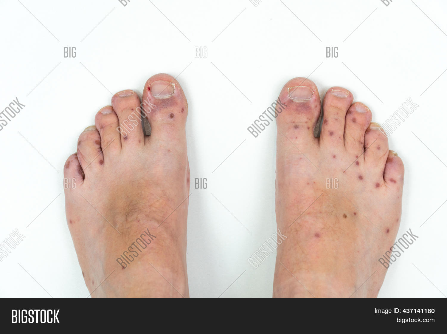 Human Legs Dermatitis Image & Photo (Free Trial) | Bigstock