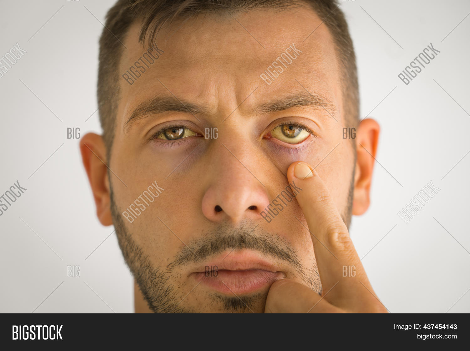 Sick Man Yellow Eyes. Image & Photo (Free Trial) | Bigstock