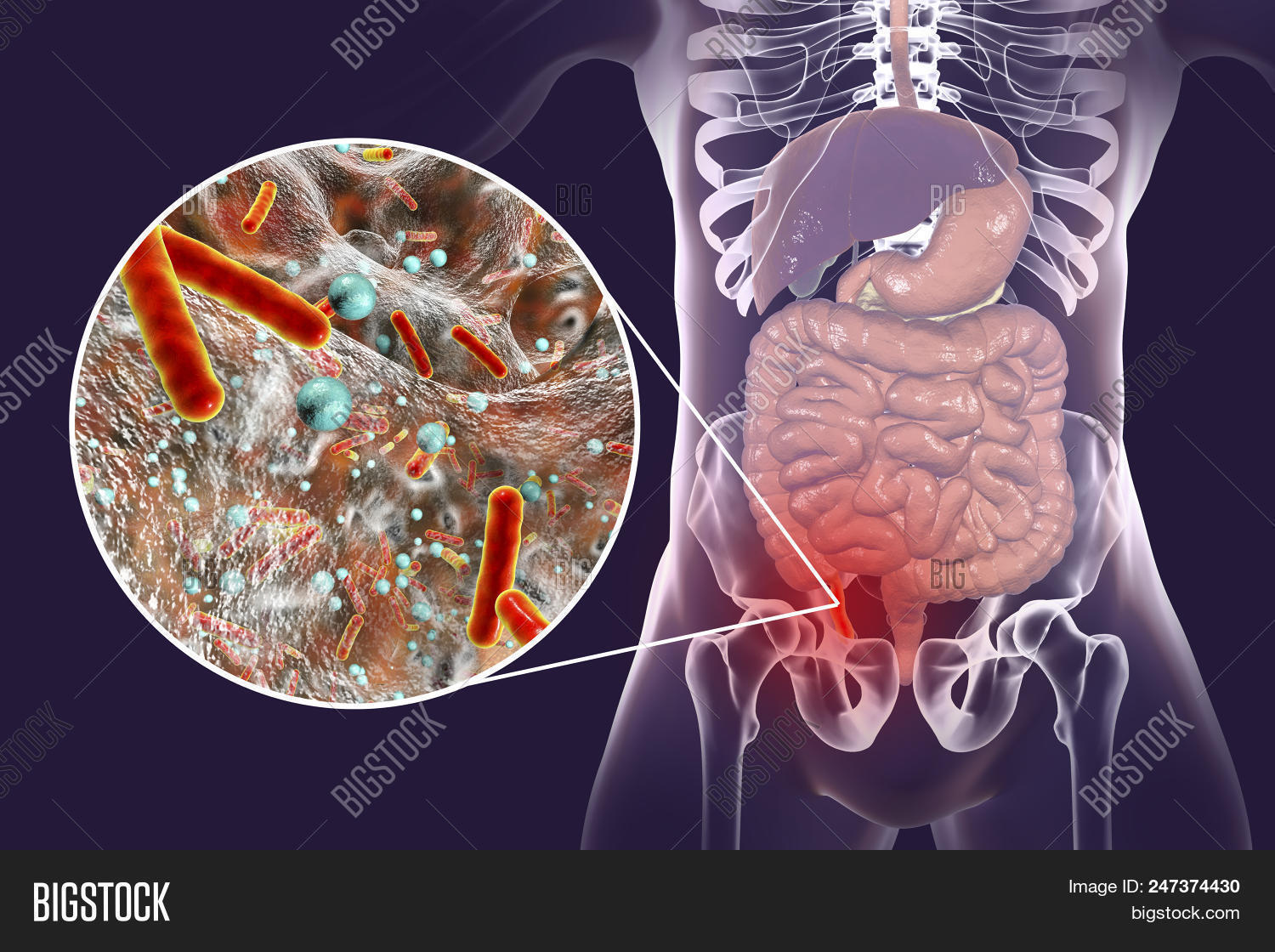 Acute Appendicitis Image & Photo (Free Trial) | Bigstock