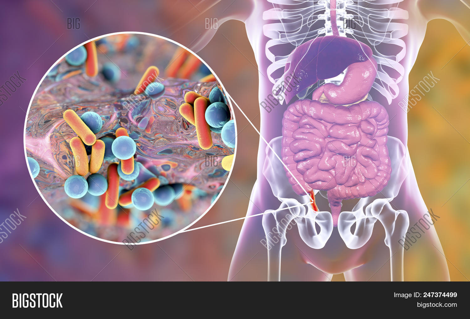 Acute Appendicitis Image & Photo (Free Trial) | Bigstock