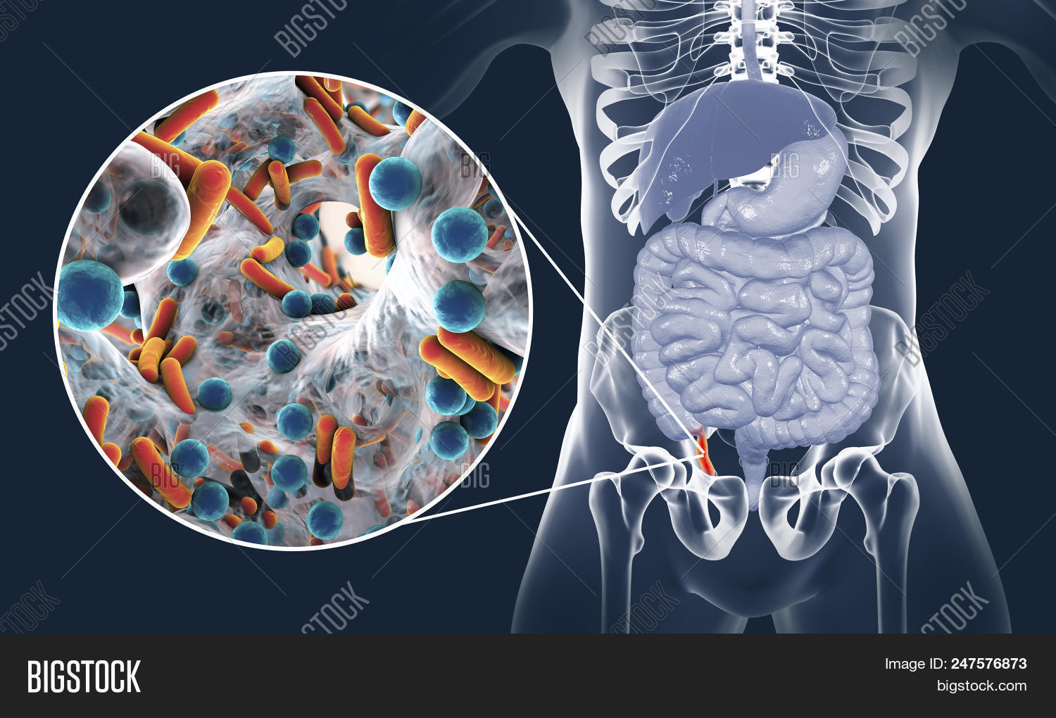 Acute Appendicitis Image & Photo (Free Trial) | Bigstock