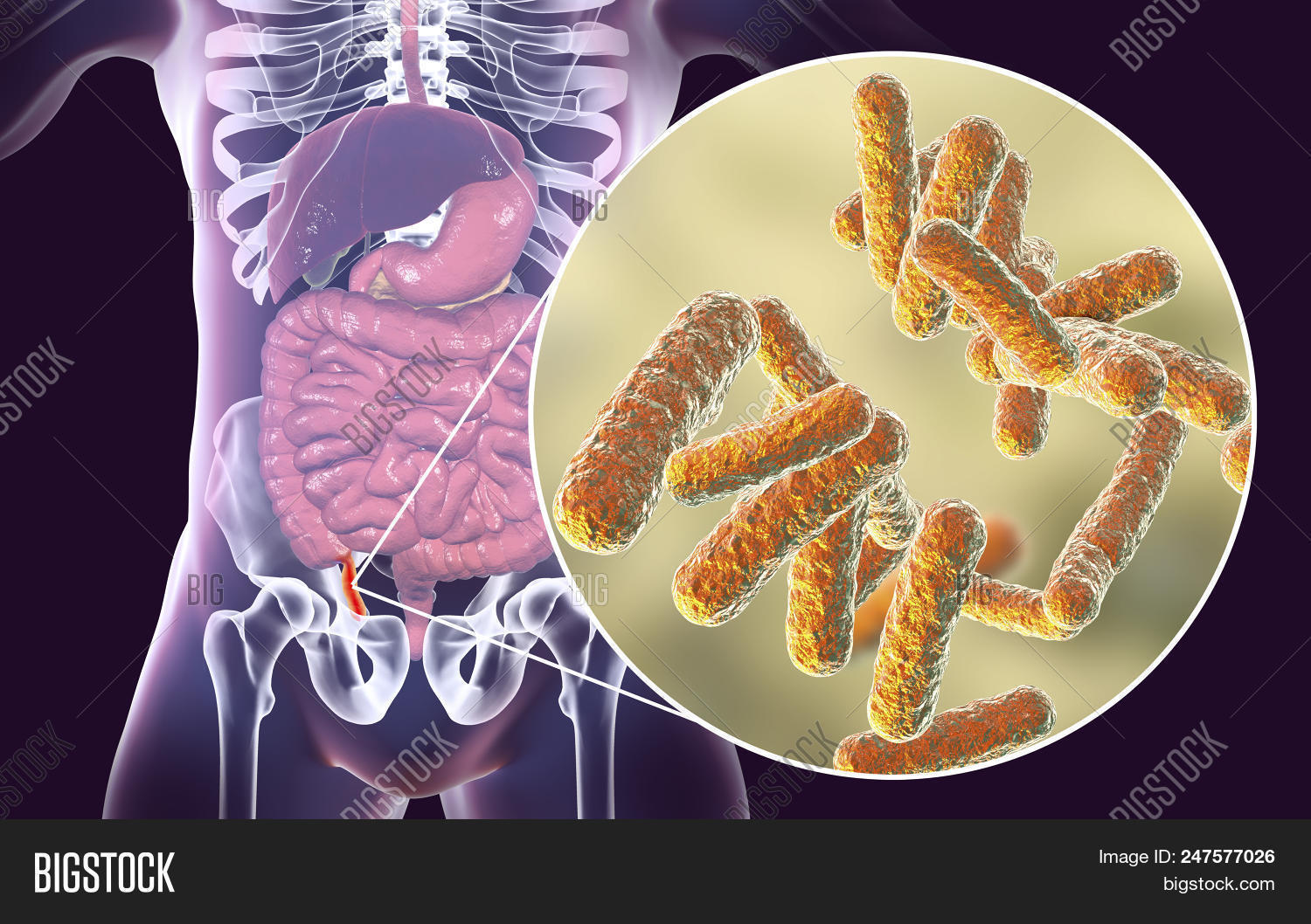 Acute Appendicitis Image & Photo (Free Trial) | Bigstock