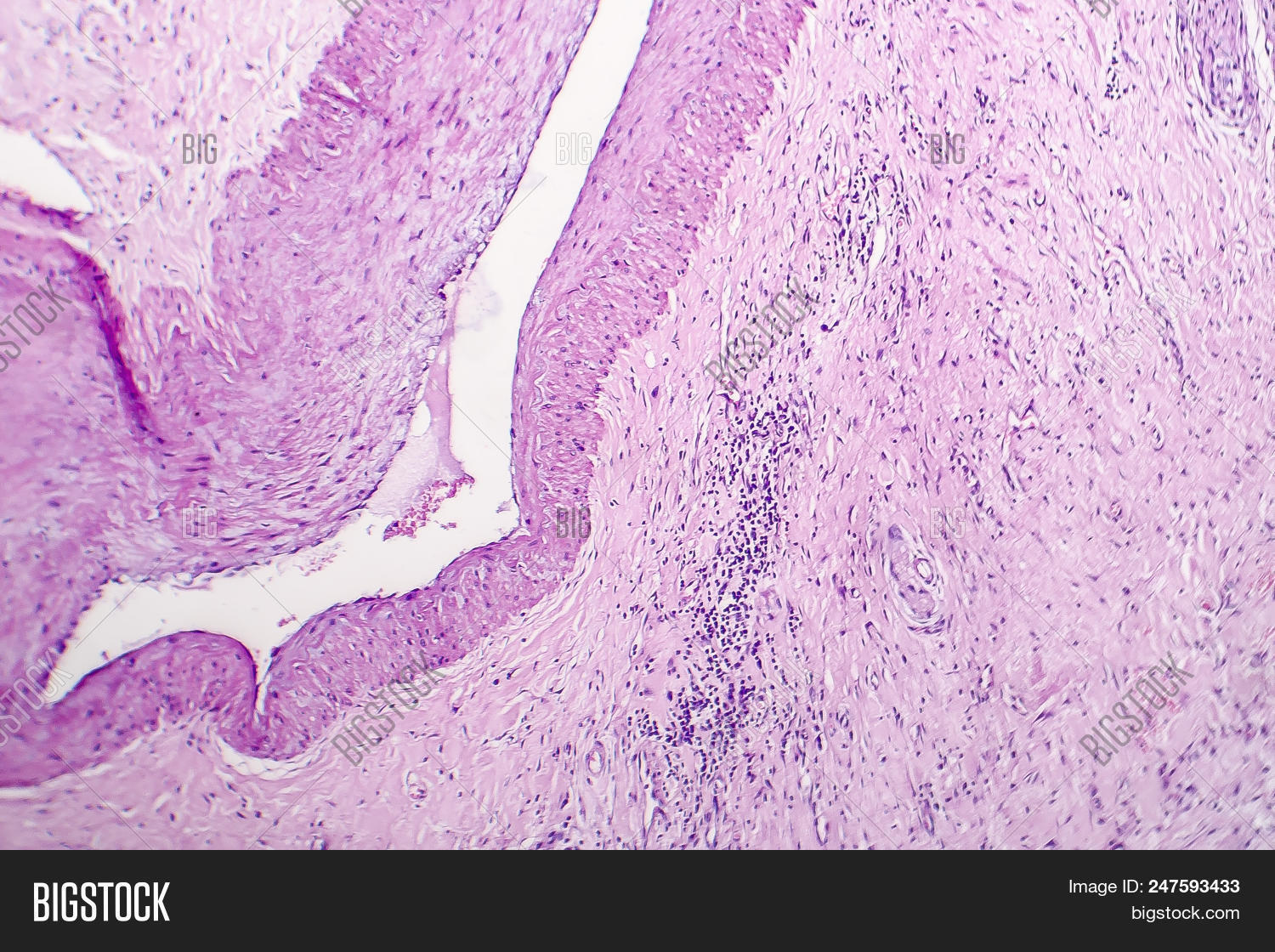 Histopathology Chronic Image & Photo (Free Trial) | Bigstock